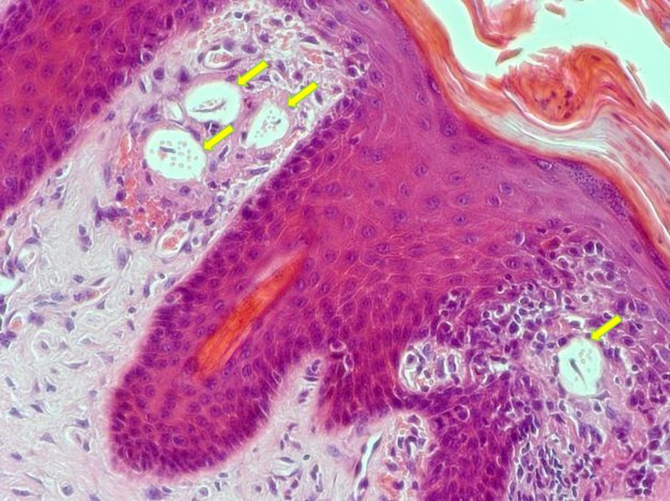 Stephanofilaria - FlyBoss